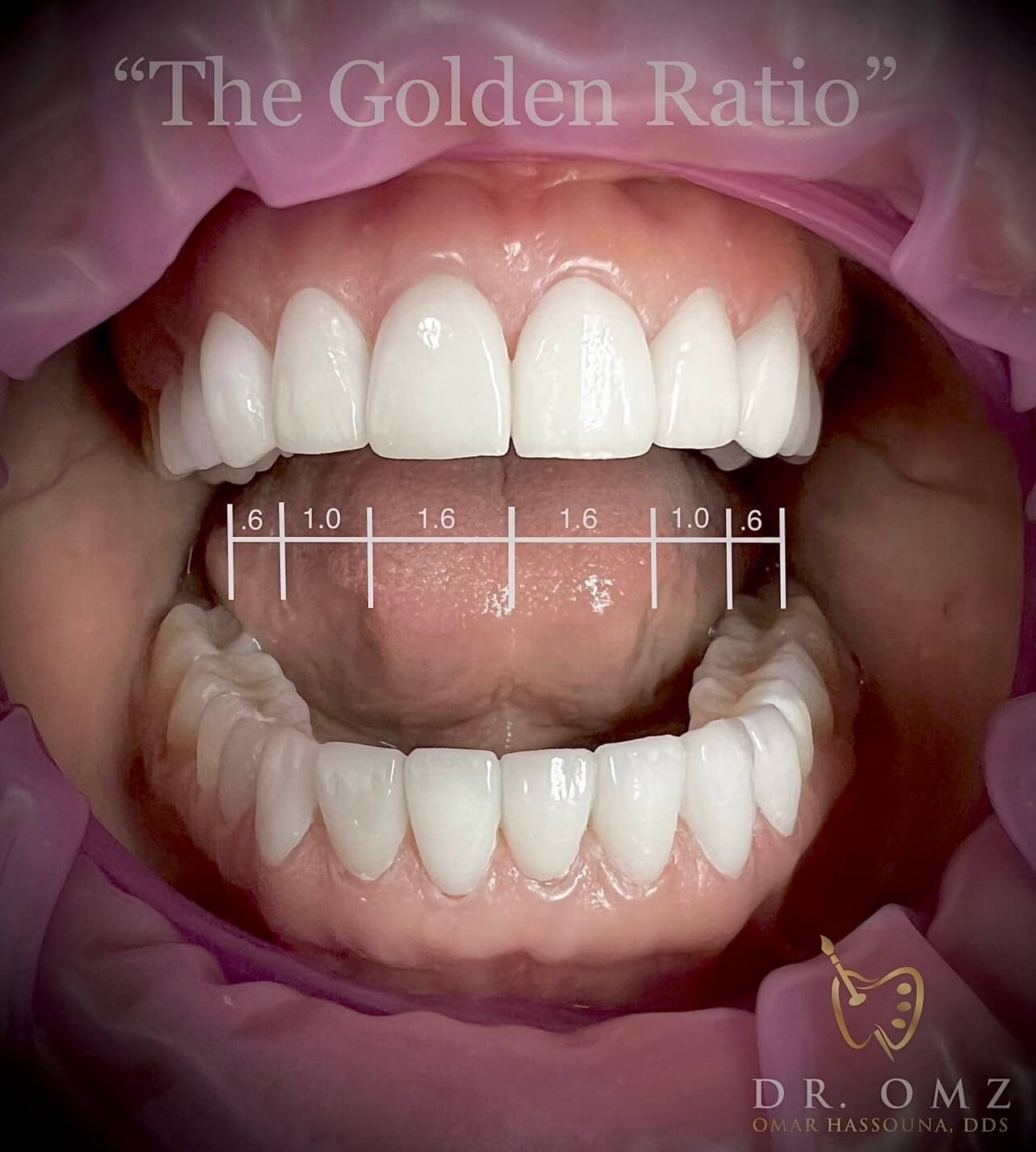 Porcelain Veneers – Dr. Omz Cosmetic Dentistry